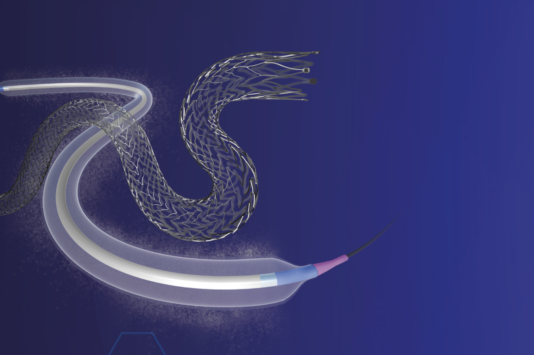 iVascular’s Luminor and iVolution Devices Evaluated for Combined Therapy in 4-Year TINTIN Data ...